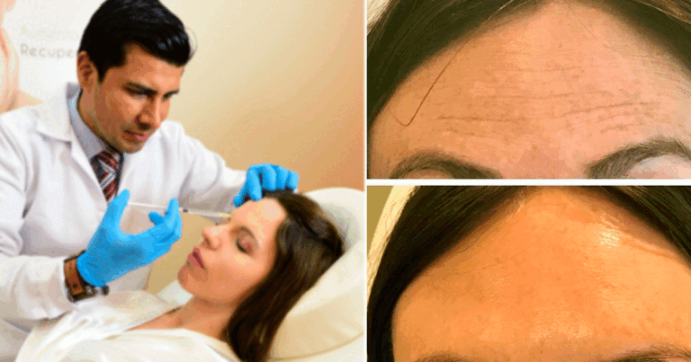 Cuánto cuesta Botox en Perú